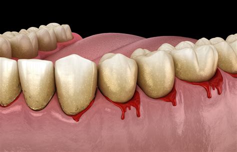 Why Do Gums Bleed Understand Your Bleeding Gums Flossy