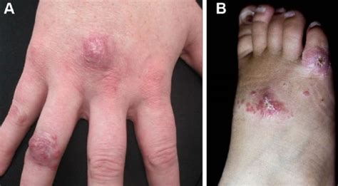 行医笔记：非结核分枝杆菌的识别 丁香园