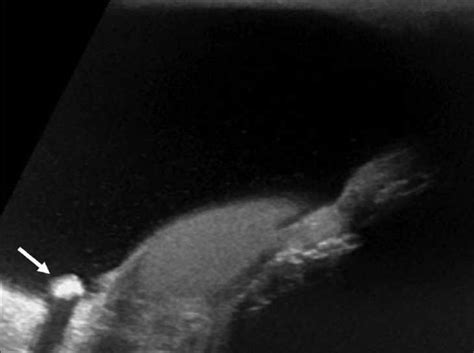 Sonographic Spectrum Of Tunica Albuginea Cyst Pmc