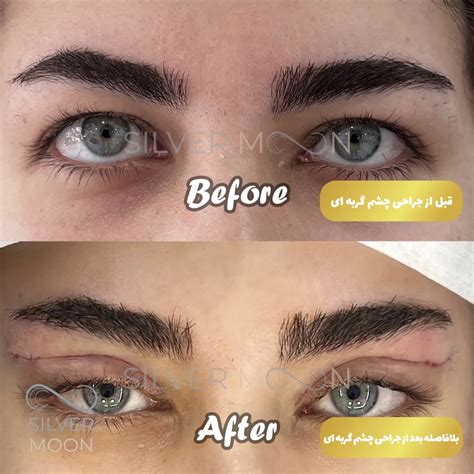 عمل زیبایی چشم گربه ای مرکز تخصصی زیبایی و پزشکی ماه نقره ای