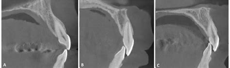 Anterior Overbite Classification A Class I B Class Ii C Class Iii