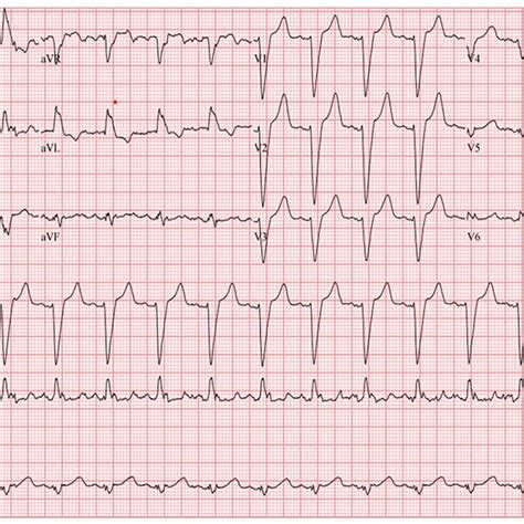Peaked T Waves Resolved After The Patients Potassium Normalized