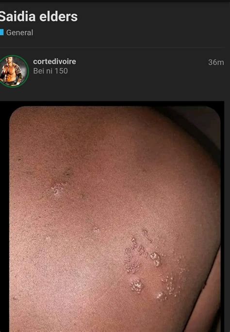 Monkey Pox Will Expose Talkers Sex And Relationships Kenya Talk