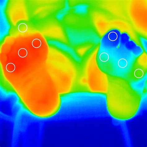 Diabetic Foot Ulcers Tfrecords Kaggle