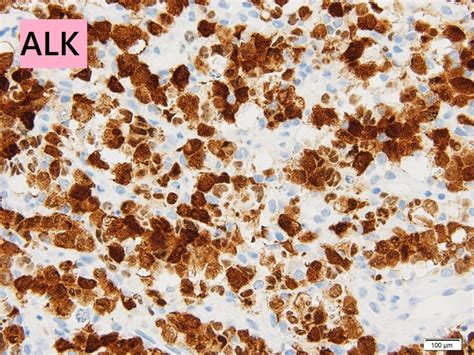 What Is Anaplastic Large Cell Lymphoma Pathosomes