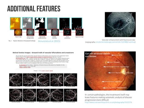 Shallow Introduction For Deep Learning Retinal Image Analysis Pdf Eye And Vision Conditions