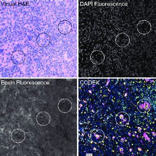 Virtual H E Staining In A Case Of Classic Hodgkin Lymphoma After CODEX