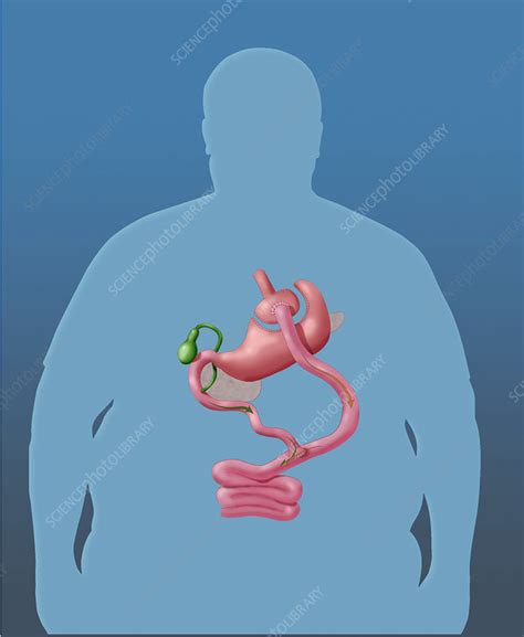 Roux En Y Gastric Bypass Surgery Stock Image C0432623 Science
