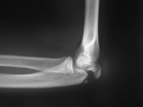 Olecranon Fractures Pediatric Pediatrics Medbullets Step 1