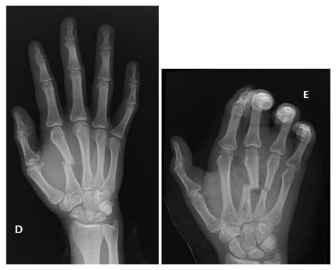 Fratura Do Metacarpo Quais São Suas Causas E Tratamentos