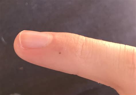 Melanoma