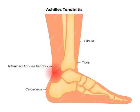 Premium Vector Achilles Tendinitis Fibula Tibia Inflamed Achiles