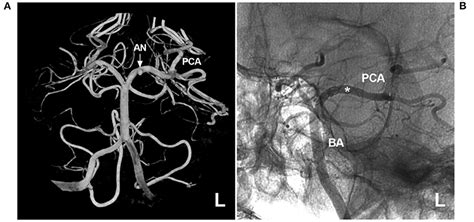 Frontiers Endovascular Treatment Of Posterior Cerebral Artery Trunk