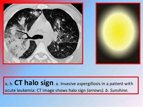 Halo Sign On Ct Invasive Aspergillosis