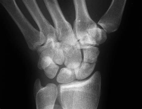Open Reduction And Internal Fixation Of Scaphoid Fractures