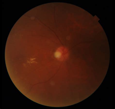 Ekacare Oct And Fundus Glaucoma Dataset · Datasets At Hugging Face