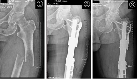 Imaging Follow Up Process Of Segmental Intercalary Prosthesis ① Download Scientific Diagram