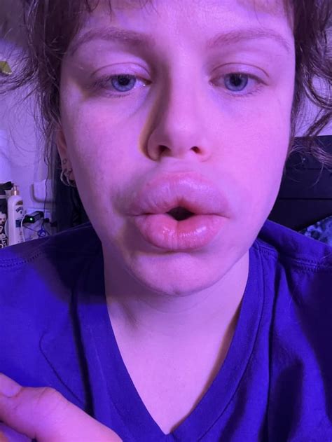 Sudden Nsaid Allergy Thanks To Hives Rhives