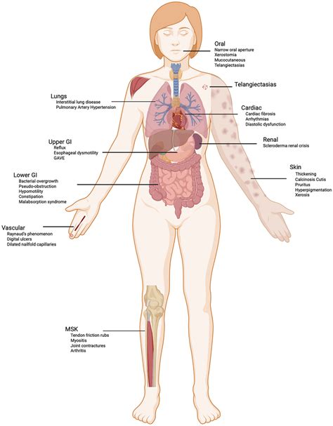 Clinical Manifestations Of Systemic Sclerosis Download Scientific Diagram