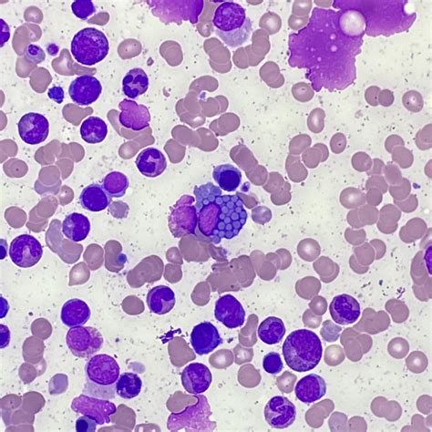 Mott Cells R Medlabprofessionals