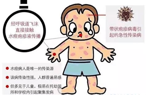 唐山市疾控中心提醒 水痘 病毒 消毒