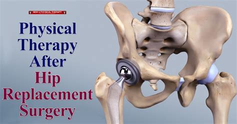 Best 12 Physical Therapy After Hip Replacement Surgery Artofit