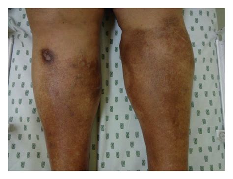 Stage 1 Skin Region Segmentation Example A Raw Skin Image B