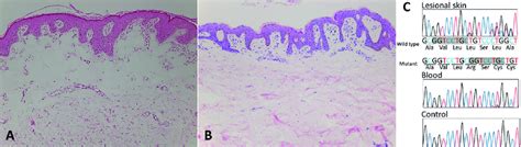 A Skin Biopsy Specimen From The Lower Leg Shows Irregular Acanthosis