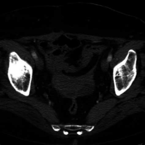 Inhomogeneous Left Ovarian Cystic Tumour Formation In Contact With Download Scientific Diagram