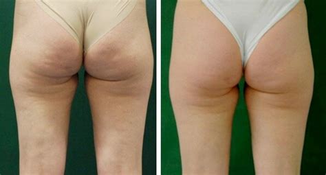 Improvement Of The Cellulite Severity Score From 10 To 6 In A Female
