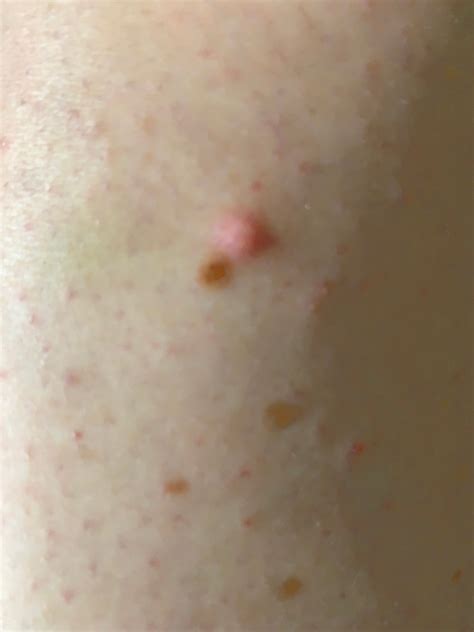 Remove Bug Bites Scars Easily And Effectively