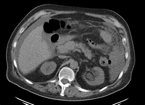 Metastatic Prostate Cancer With Peritoneal Carcinomatosis Eurorad