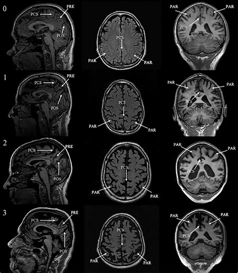 Posterior Cortical Atrophy Clinical Tree