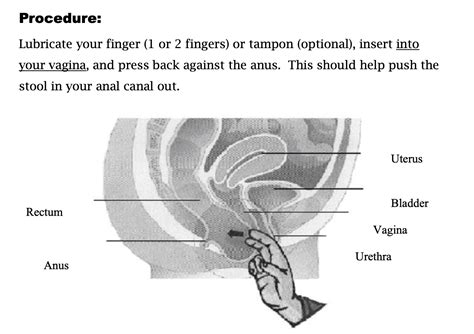 Splinting The Popular Constipation Relief Tiktok Trend