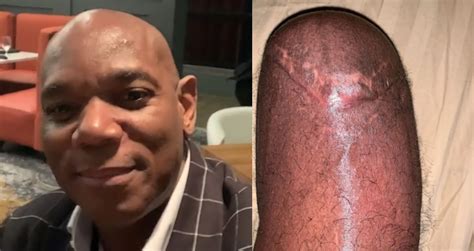Flex Wheeler Reveals Never Before Seen Graphic Photo Of Amputated Leg