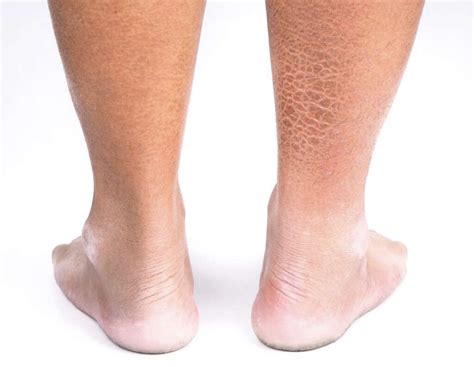 Ichthyosis What Is Ichthyosis