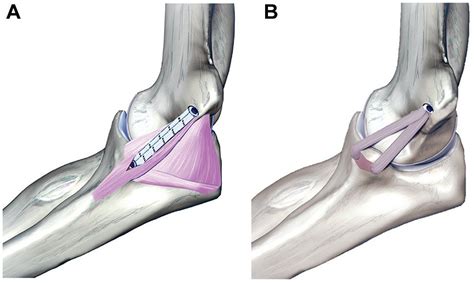 Elbow Surgery Aptiva Health