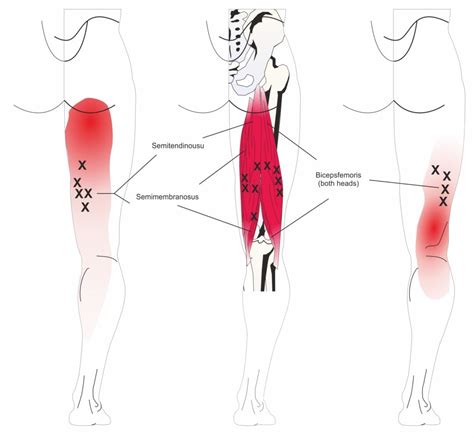 Pulled Hamstring Diagnosis At Liam Hinkler Blog