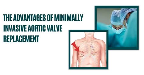 The Advantages Of Minimally Invasive Aortic Valve Replacement By Medical And Health Medium