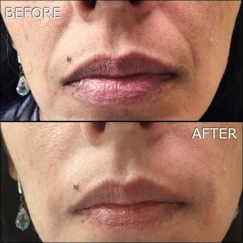 Botox Marionette Lines Before And After 19 Facial Injections Info Prices Photos Reviews Qanda