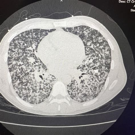 Presumed Miliary Tb R Radiology