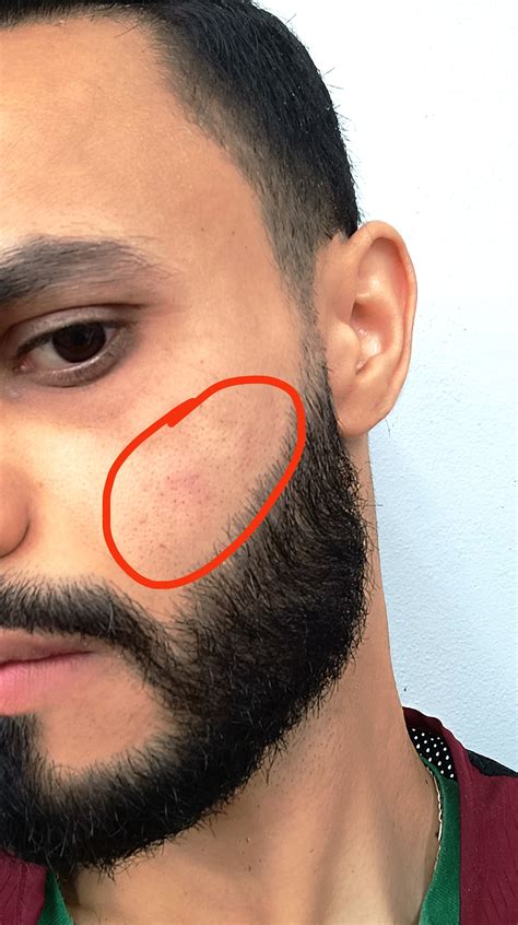 Hyperpigmentation Persists Months After Electrolysis Professional