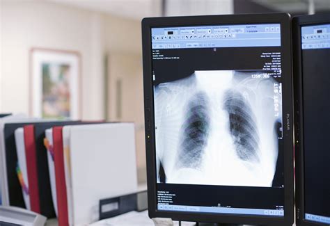 Chest X Ray Uses Side Effects Procedure Results