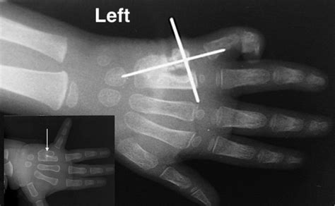 Metacarpal Synostosis Hand Surgery Resource