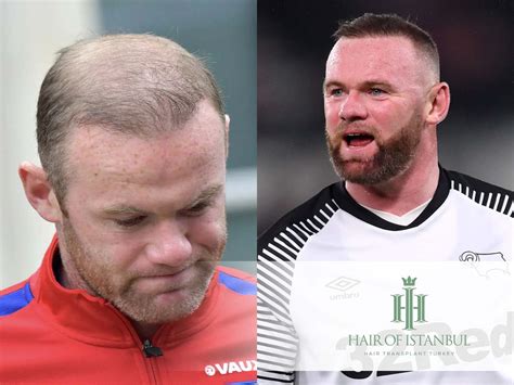 Wayne Rooney Hair Transplant The Story Behind His New Look