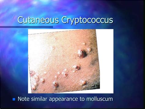 Ppt Understanding Neurologic Complications Of Hiv Aids Key Diagnoses