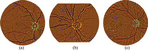 examples of the microaneurysms segmentation with p ma download