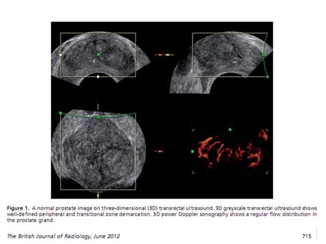 BÀi SoẠn VỀ SiÊu Âm ChẨn ĐoÁn 3d Transrectal Ultrasound Of Prostate Cancer
