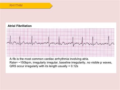How To Calculate Heart Rate Using Ecg Haiper