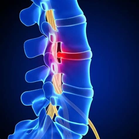 Протрузия межпозвонковых дисков Институт лечения боли